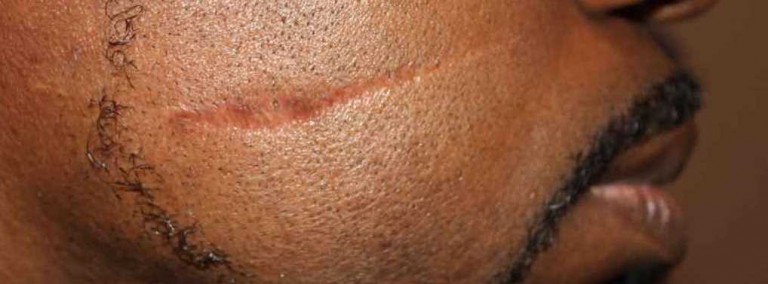 Scar Facts and Removal Treatments - Frank Media Inc